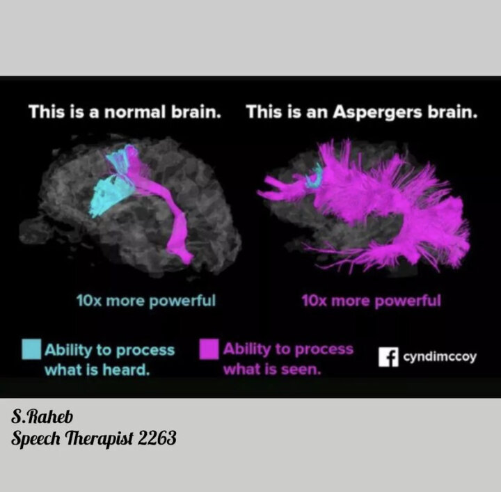 Aspergers brain vs “normal” brain | Autism Spectrum Disorder (ASD)