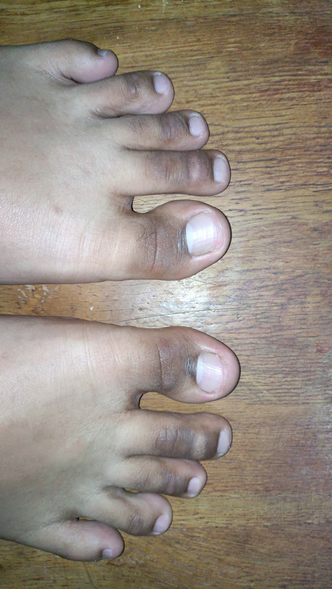 Toes Hyperpigmentation Is there a way to lessen or remove the ...