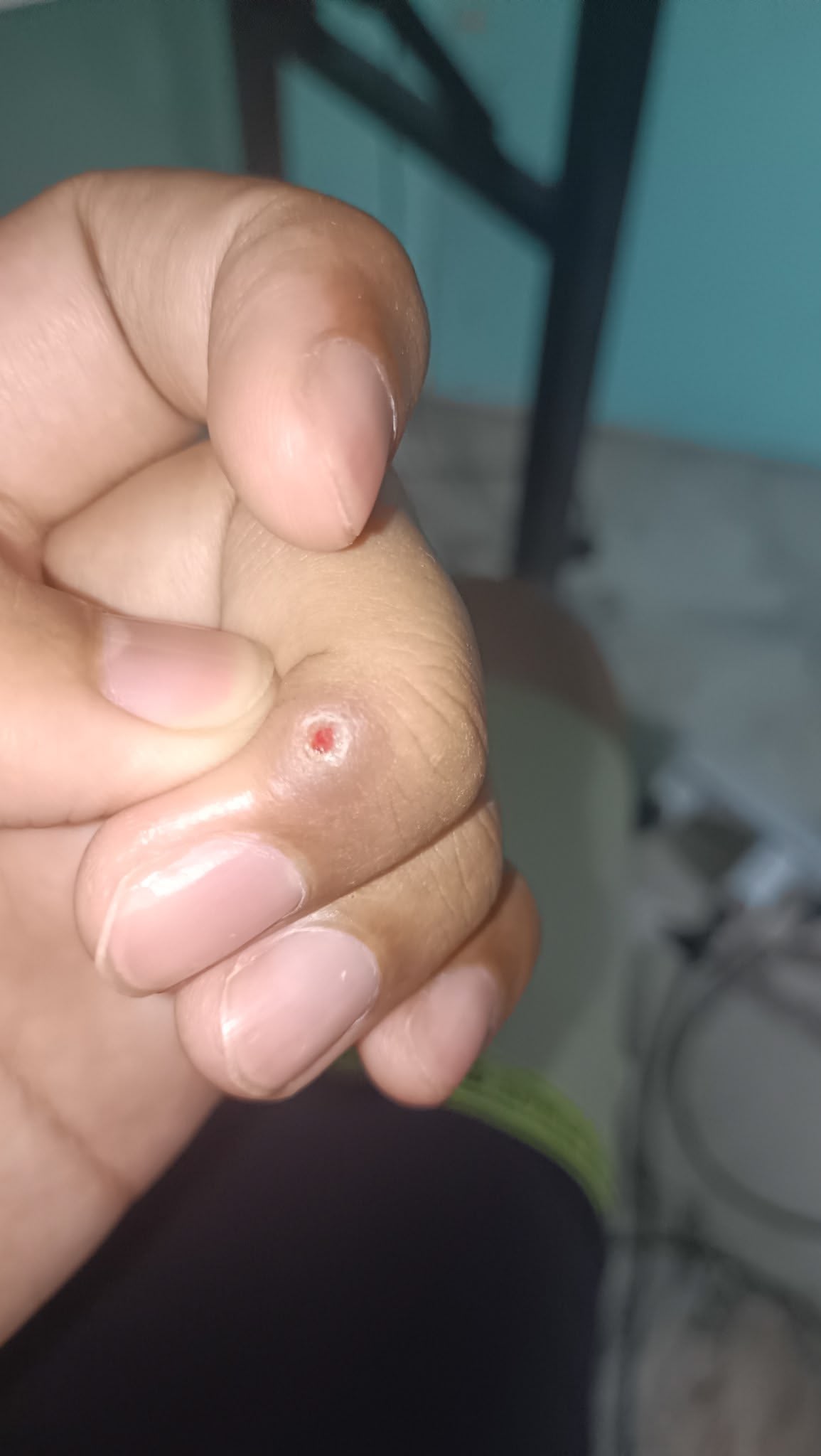 What to do? Warts I have this wart for years I once cut it with a nail ...