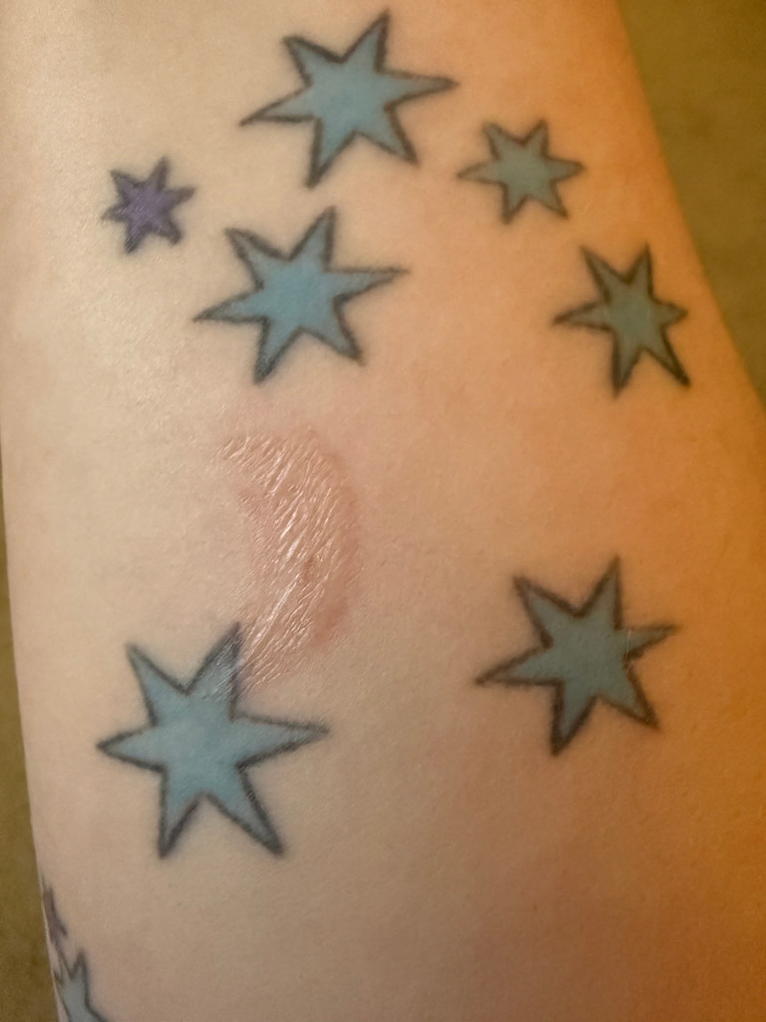 I wanted to pop it 😒 I accidentally burned the underside of my forearm ...